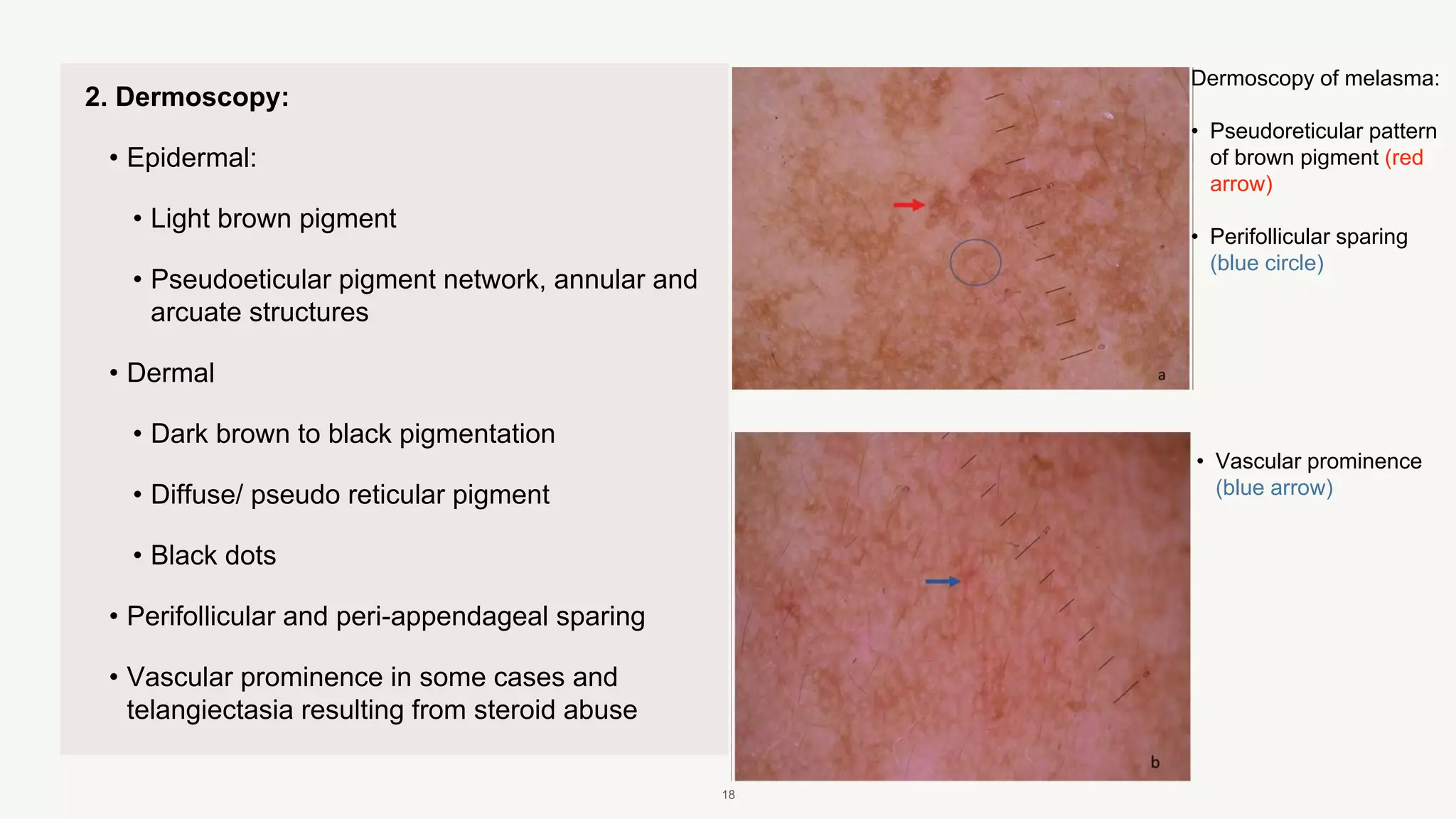 Facial Melanosis.pptx