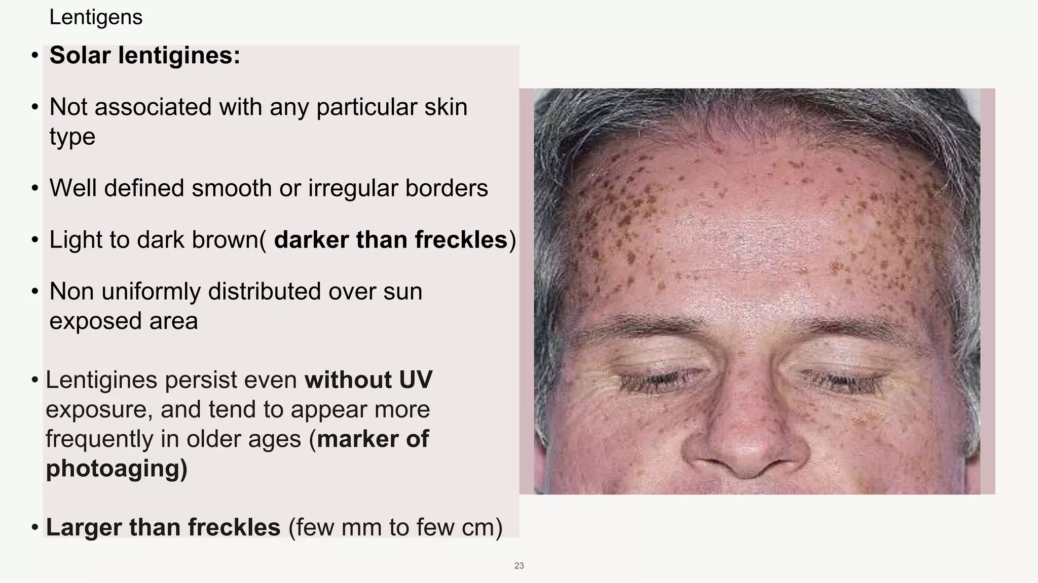 Facial Melanosis.pptx