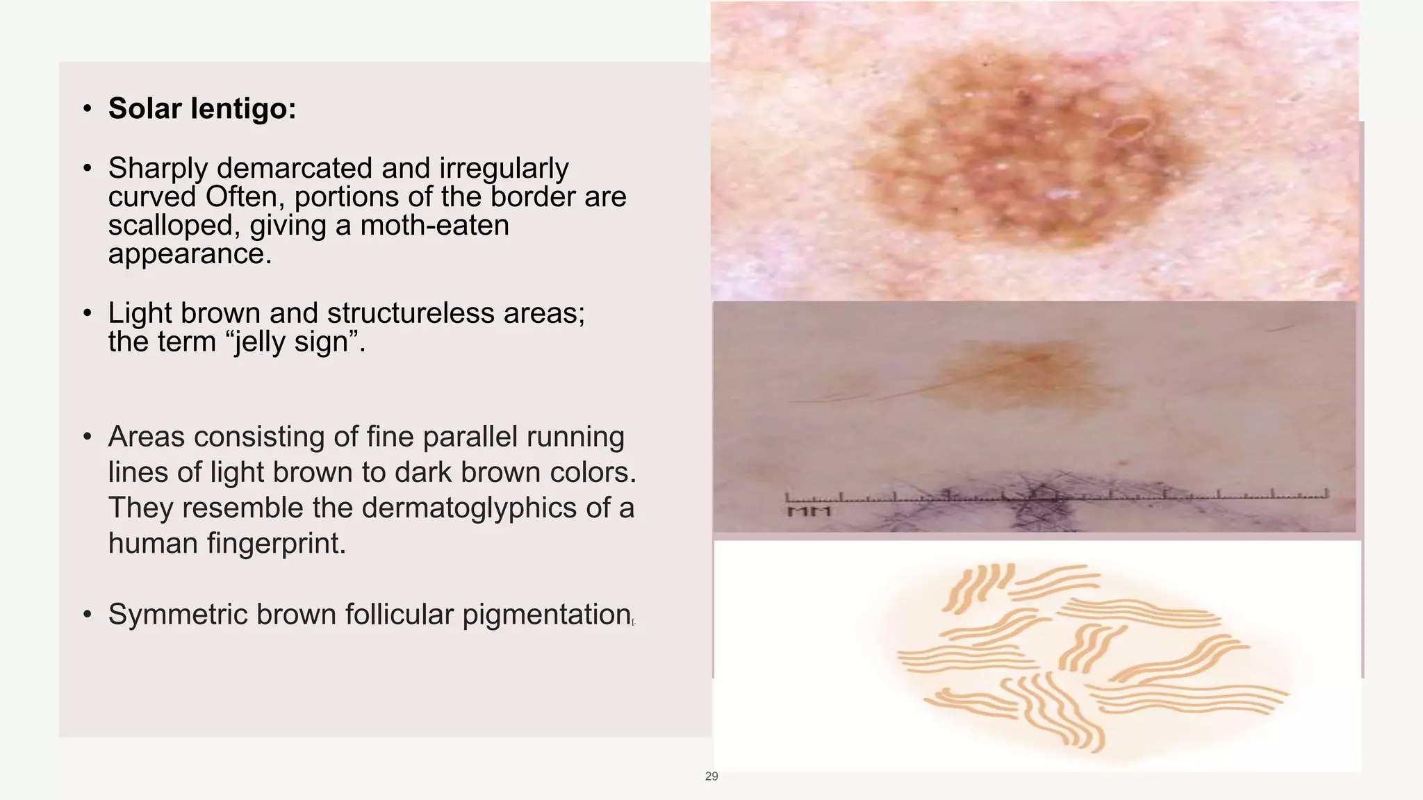 Facial Melanosis.pptx