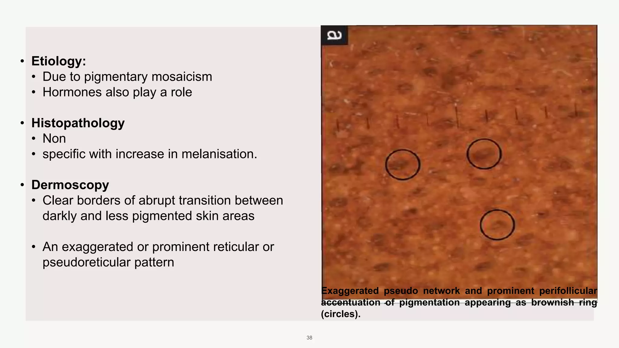 Facial Melanosis.pptx
