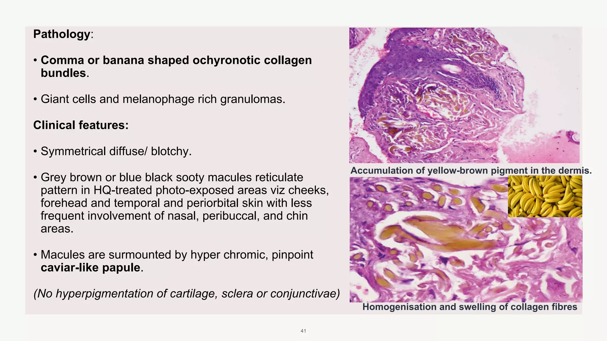 Facial Melanosis.pptx