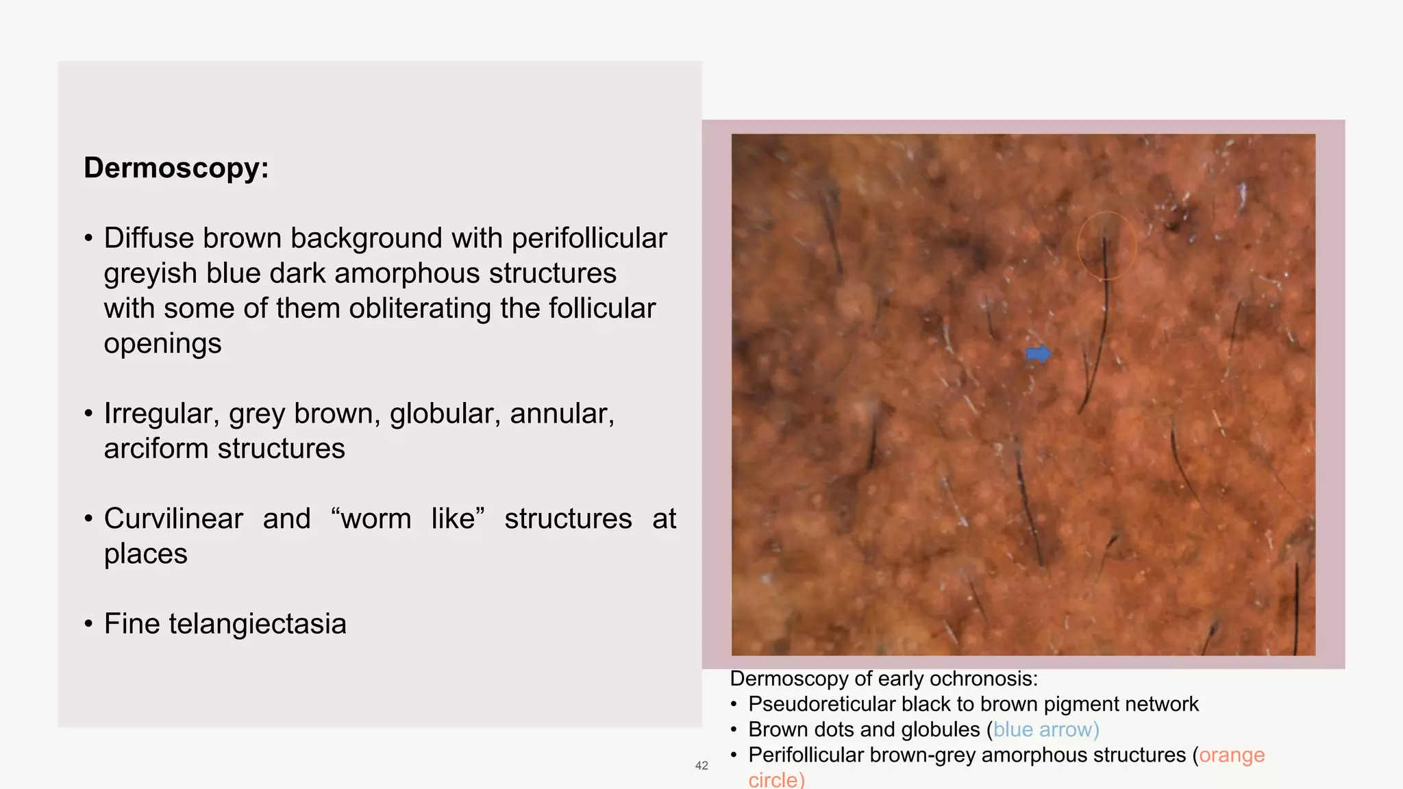 Facial Melanosis.pptx