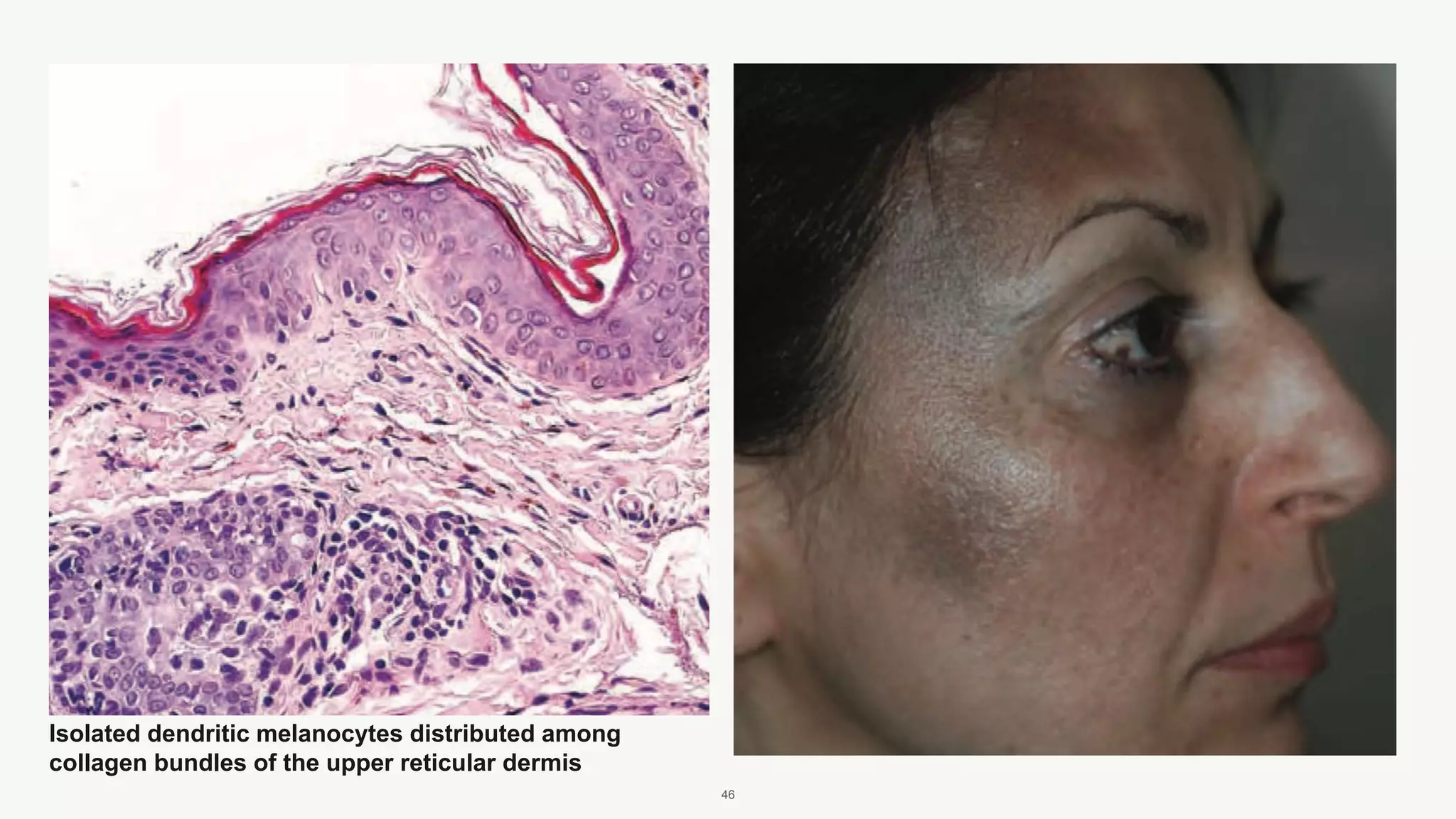 Facial Melanosis.pptx