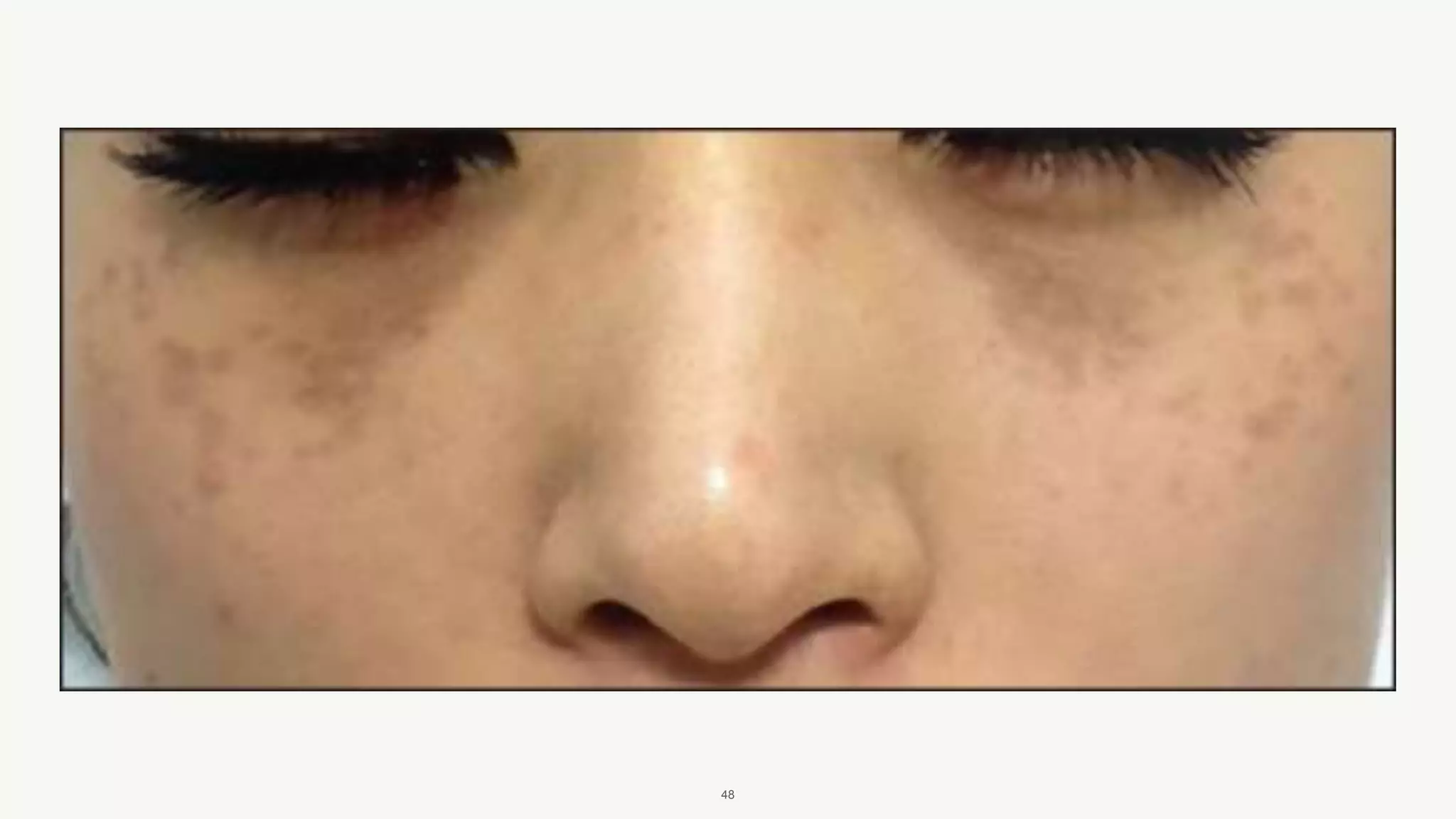 Facial Melanosis.pptx