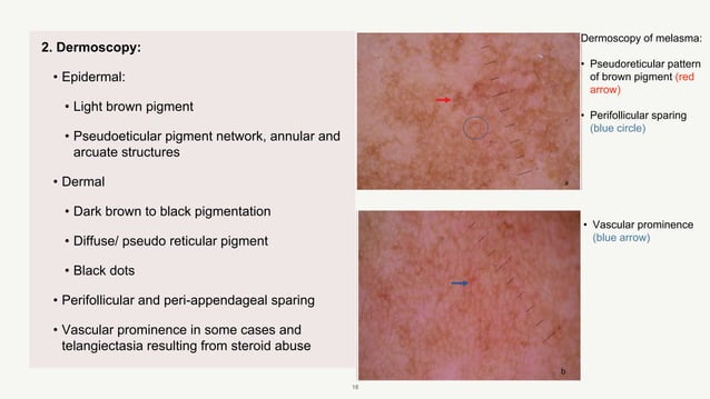 Facial Melanosis.pptx | Skin and Dermatology | Diseases and Conditions