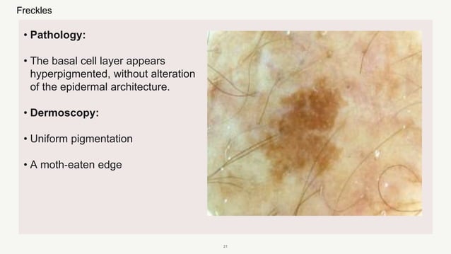 Facial Melanosis.pptx | Skin and Dermatology | Diseases and Conditions