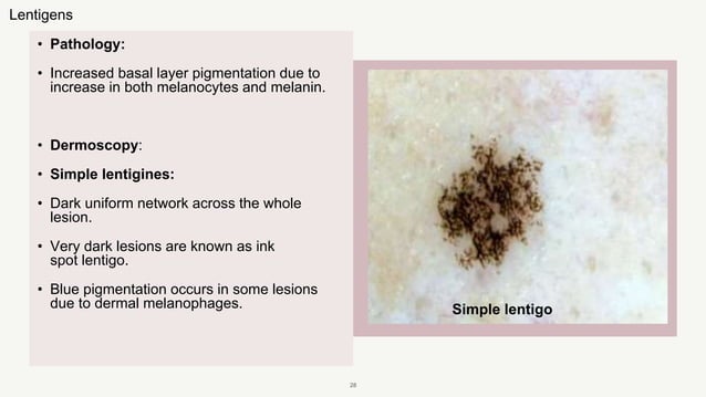 Facial Melanosis.pptx | Skin and Dermatology | Diseases and Conditions