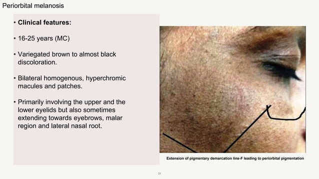 Facial Melanosis.pptx | Skin and Dermatology | Diseases and Conditions