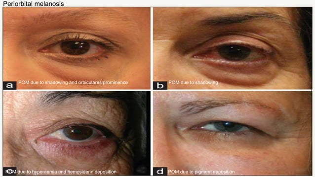 Facial Melanosis.pptx | Skin and Dermatology | Diseases and Conditions