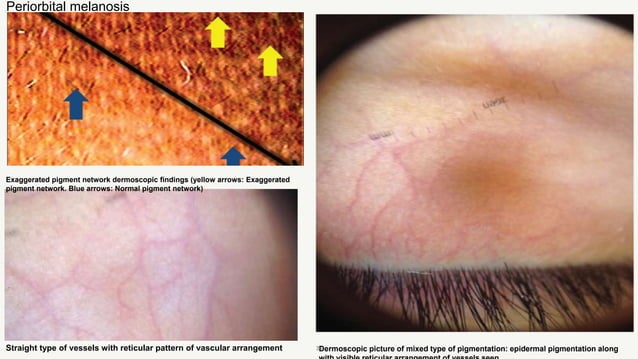 Facial Melanosis.pptx | Skin and Dermatology | Diseases and Conditions