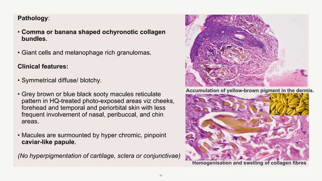 Facial Melanosis.pptx | Skin and Dermatology | Diseases and Conditions