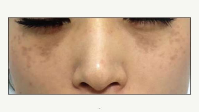 Facial Melanosis.pptx | Skin and Dermatology | Diseases and Conditions
