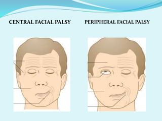 Facial Nerve Pptx