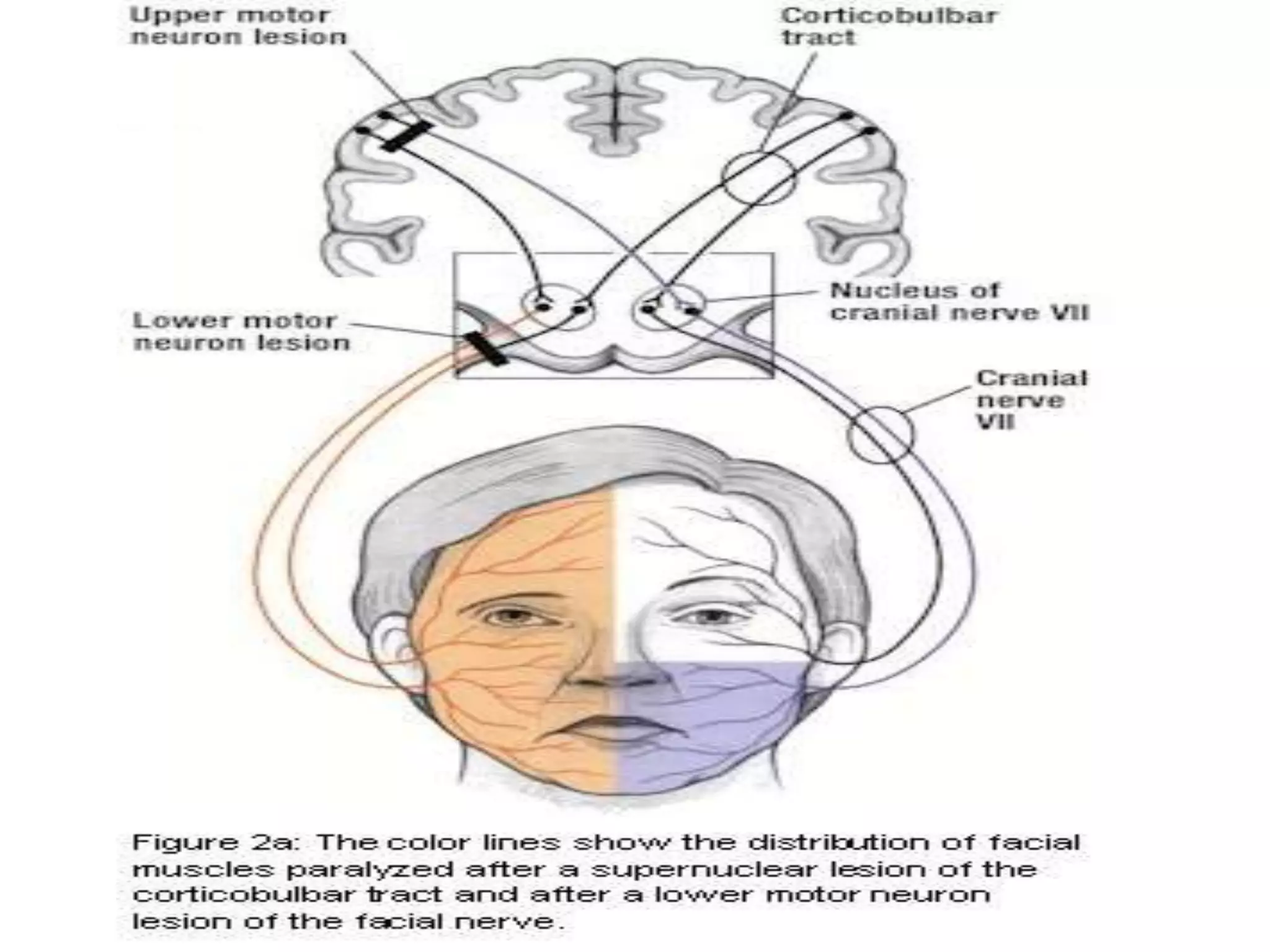 Facial nerve traumatic injury and repair | PPTX