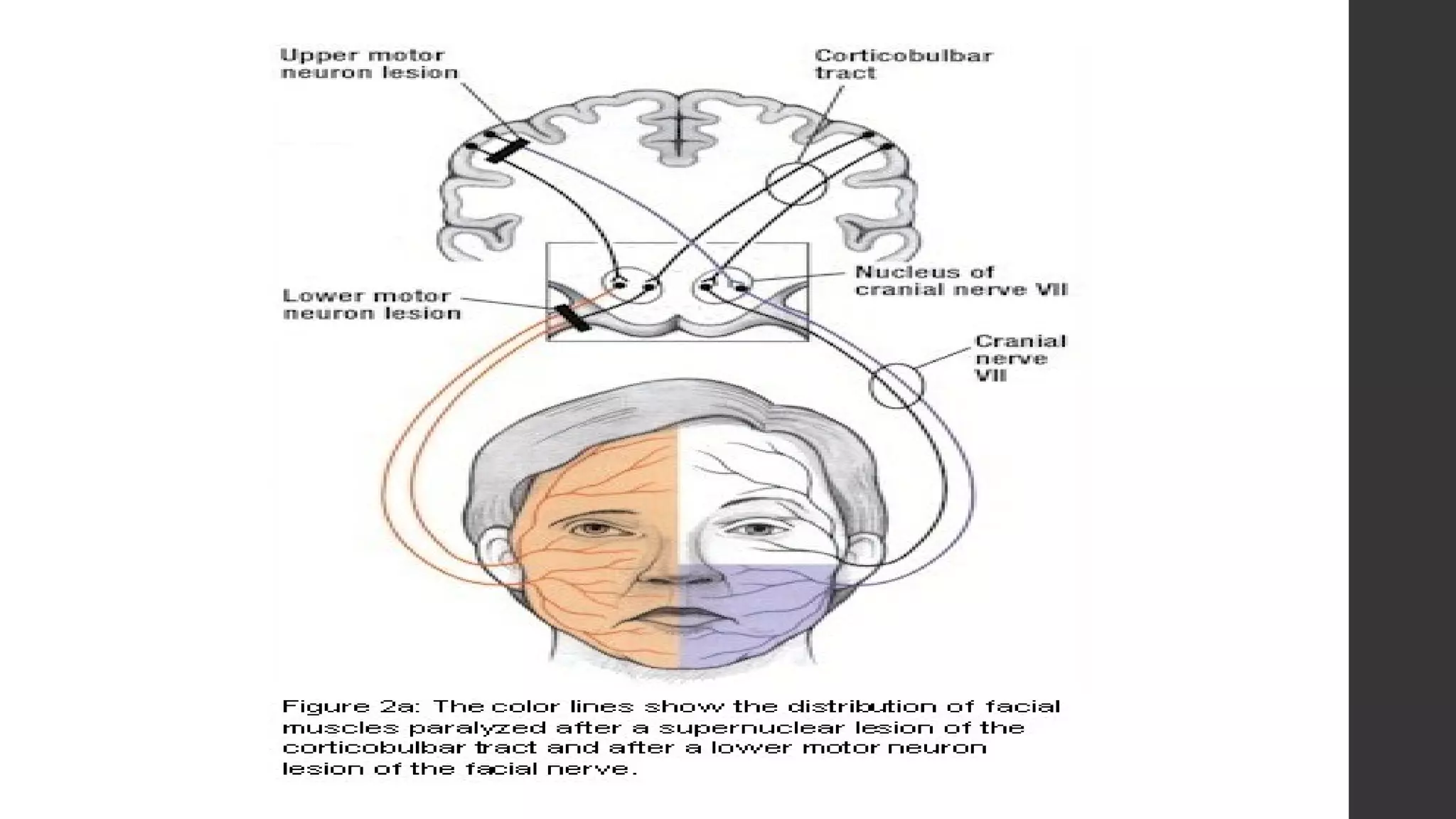 Facial Nerve Paralysis | PPT
