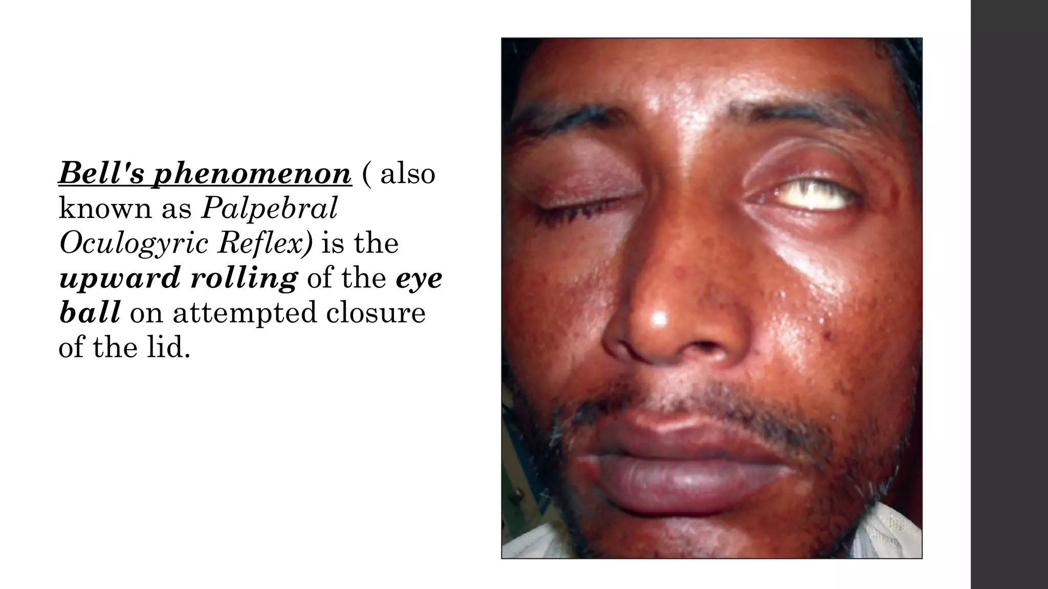 Facial Nerve Paralysis | PPT