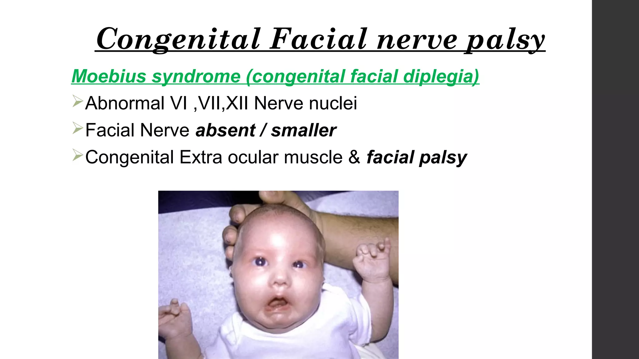 Facial Nerve Paralysis | PPT