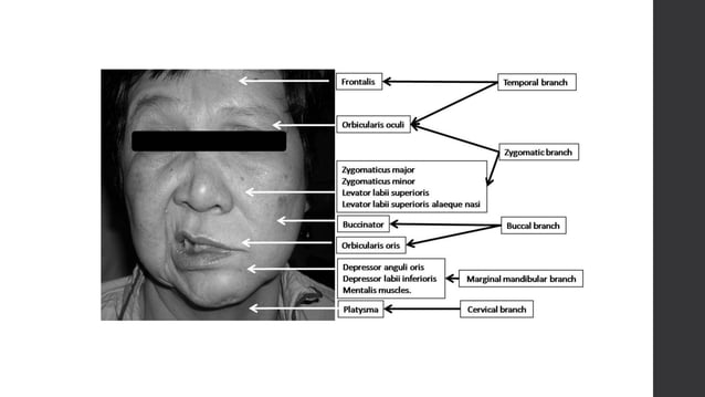 Facial Nerve Paralysis | PPT