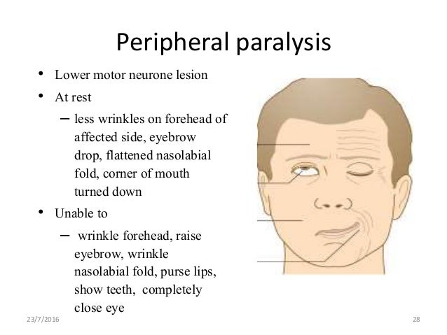 Facial nerve