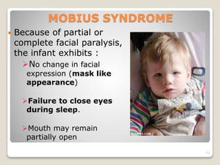 Facial nerve | PPTX