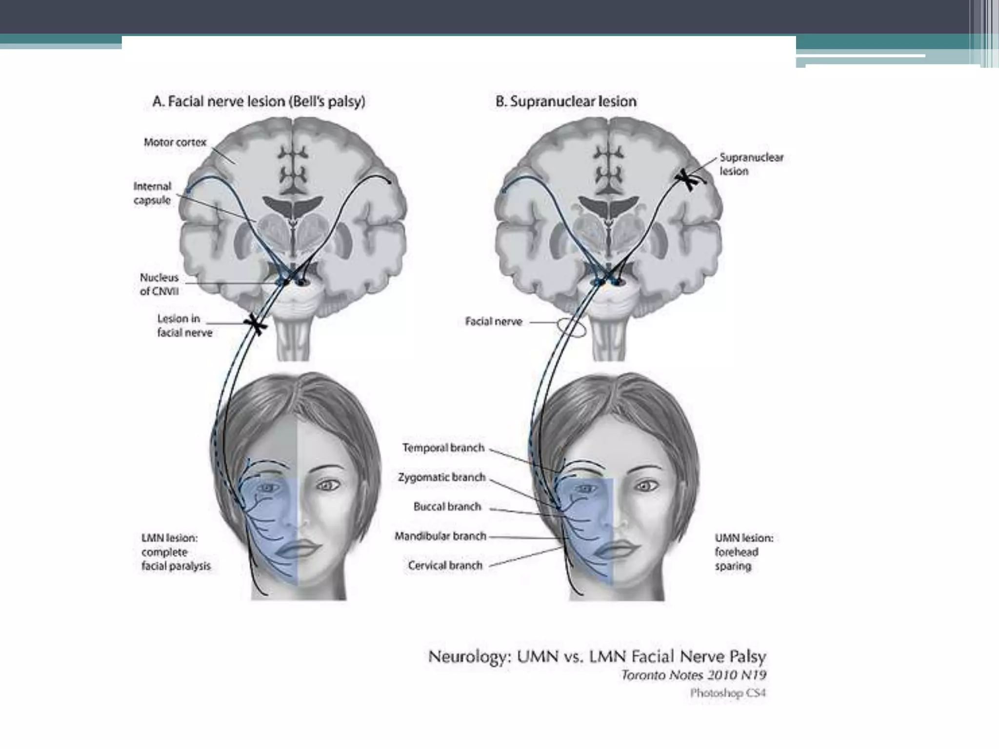Facial nerve and its disorders | PPTX