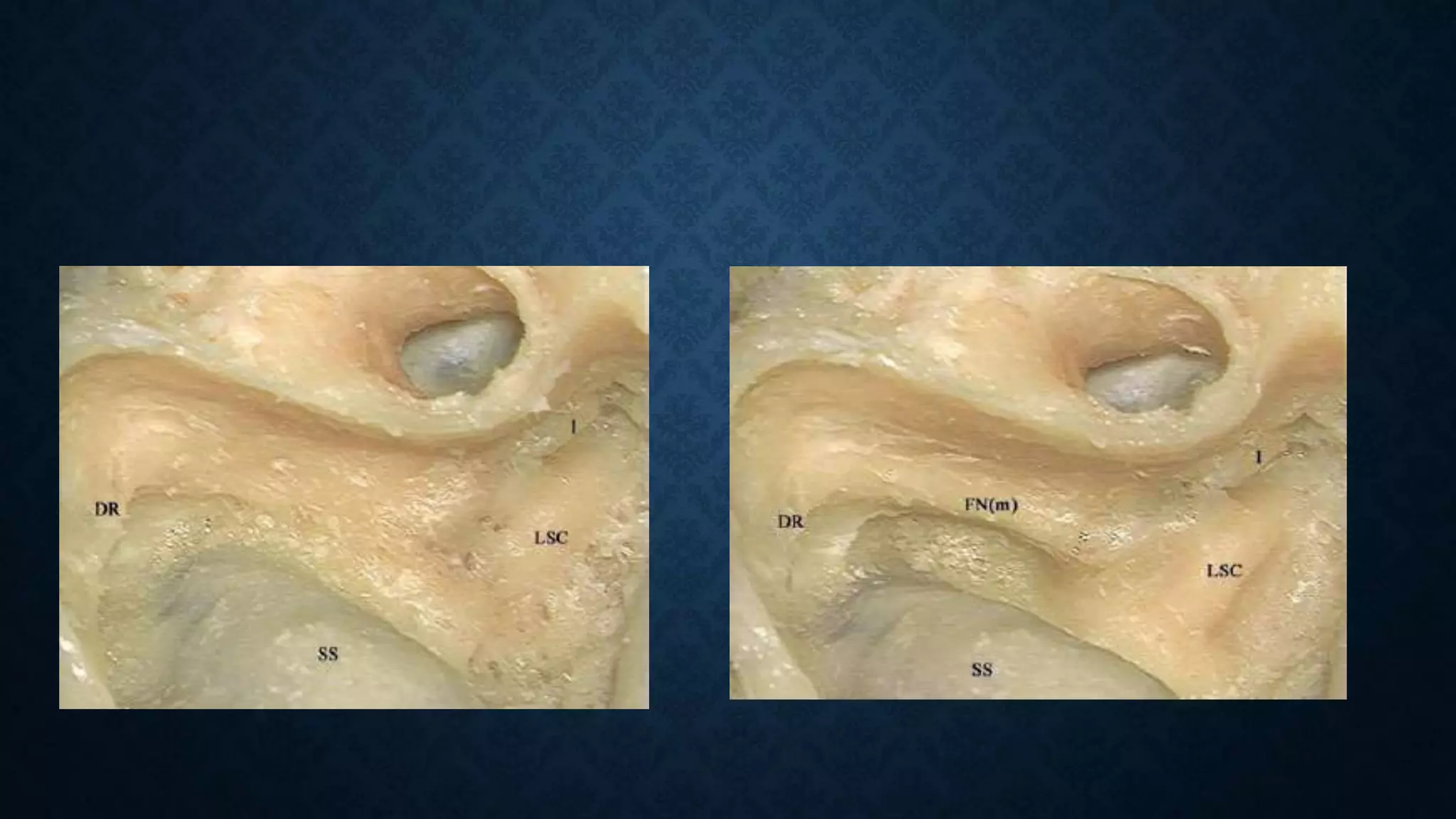 Facial nerve decompression | PPTX