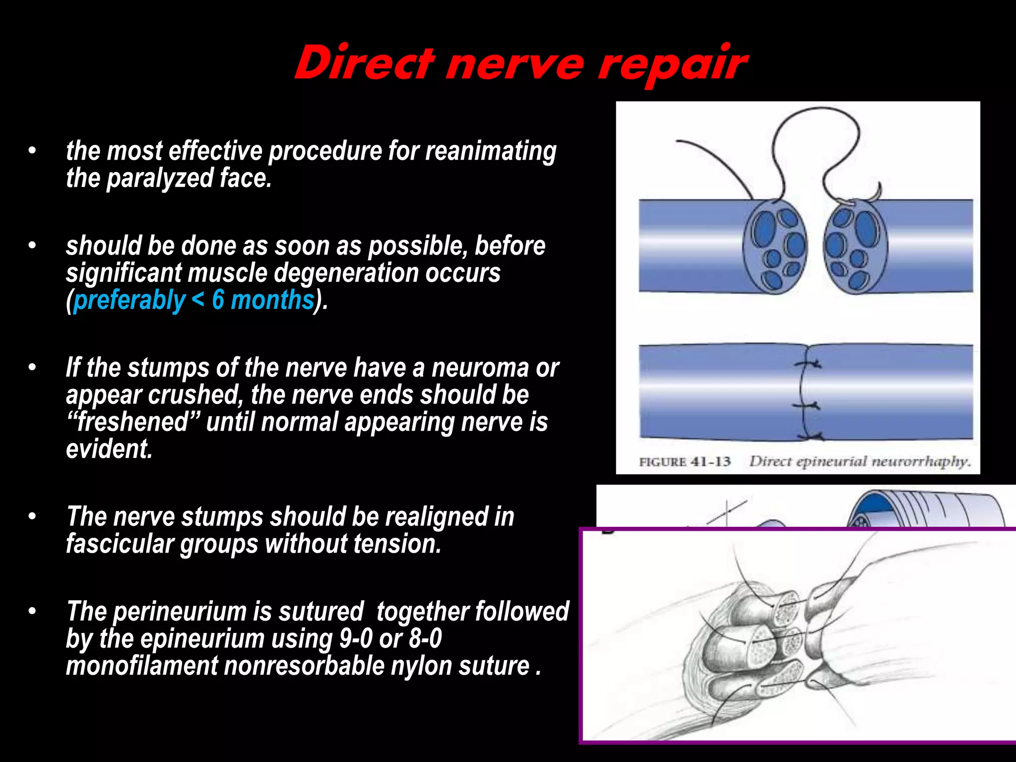 Facial nerve injury and reanimation | PPTX