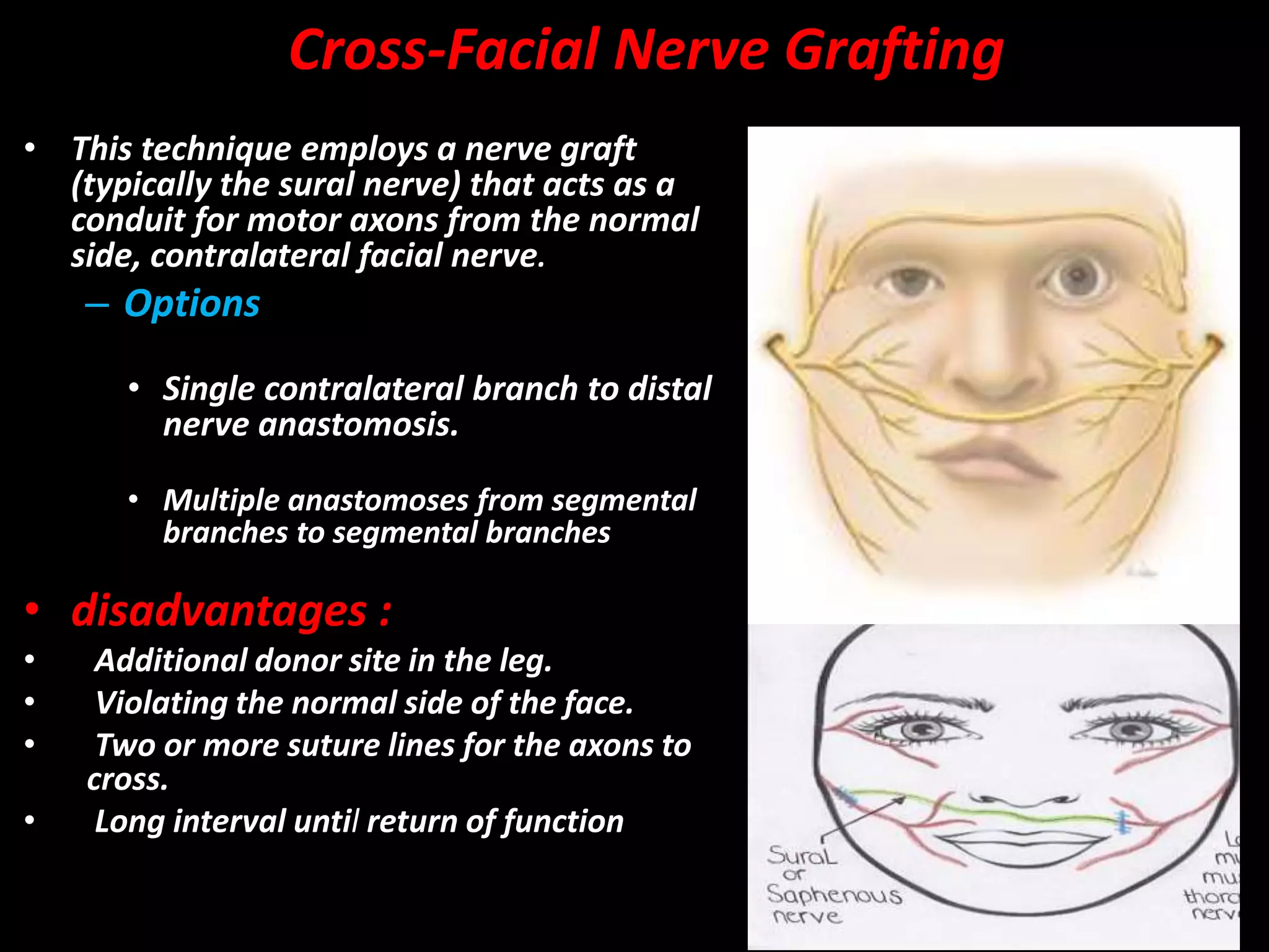 Facial nerve injury and reanimation | PPTX