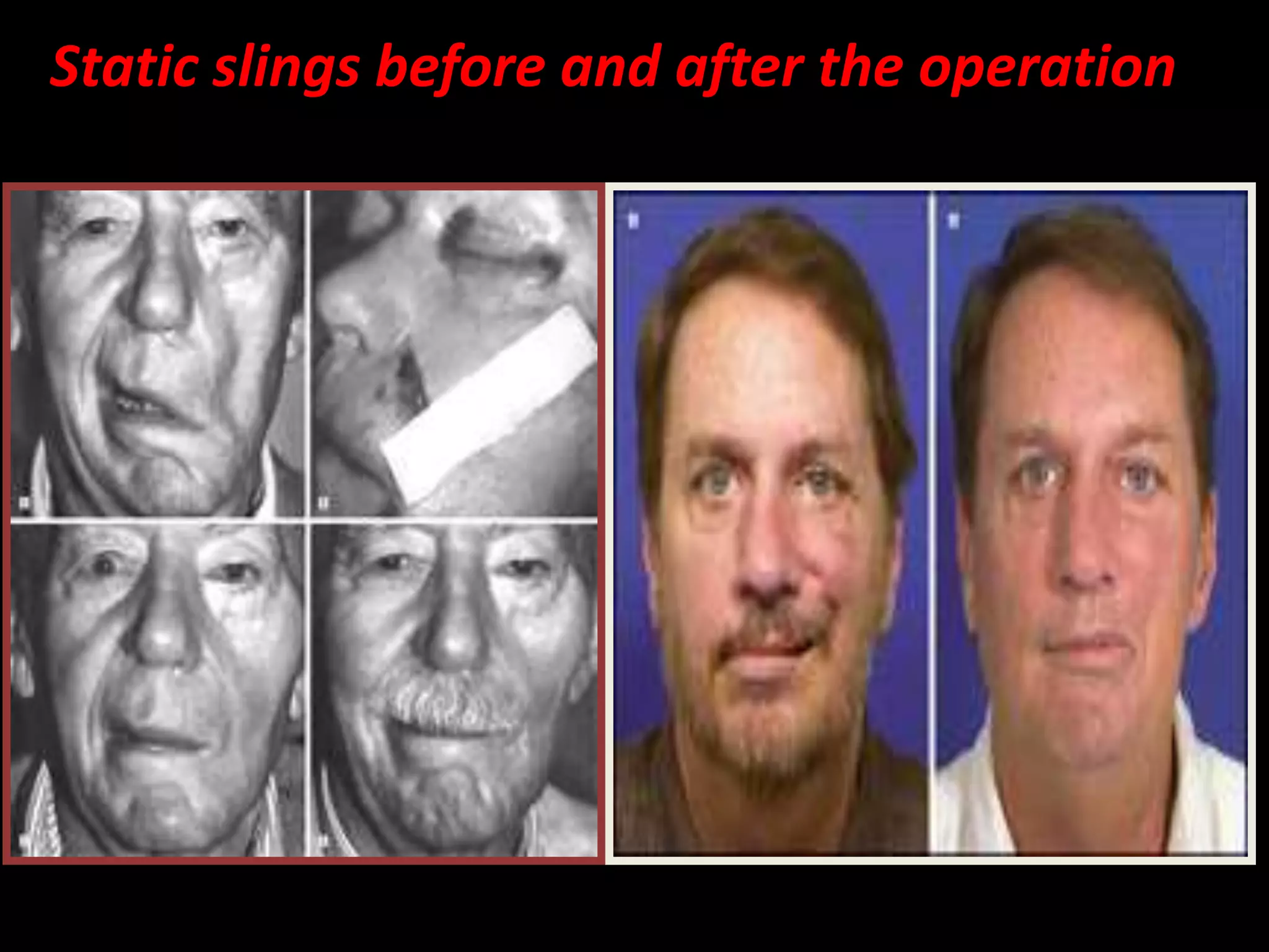 Facial nerve injury and reanimation | PPTX