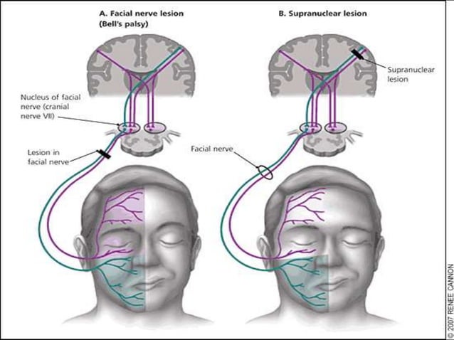 Facial nerve injury and reanimation | PPTX