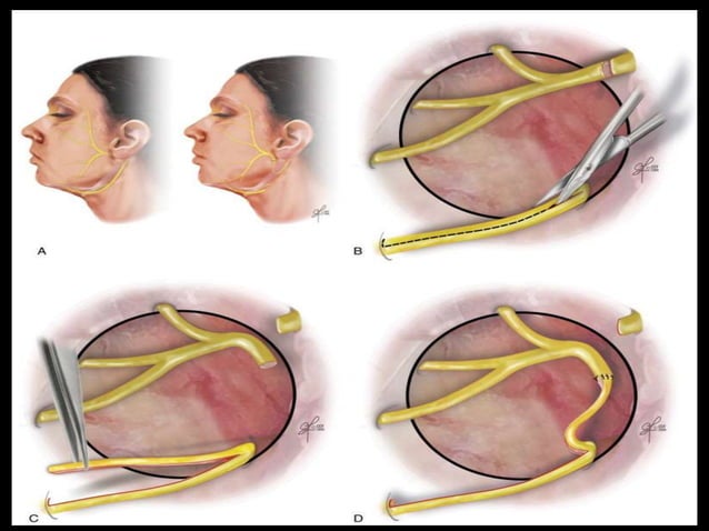 Facial nerve injury and reanimation | PPTX