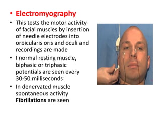 Facial Nerve lesions | PPTX