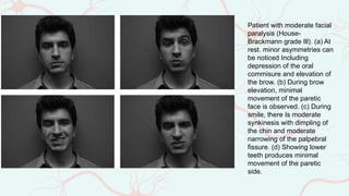 facial nerve motor lesions conditions .pptx