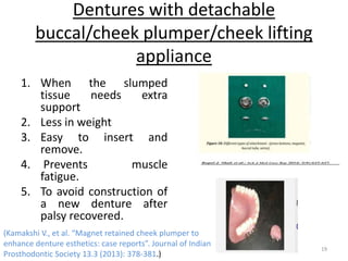 Facial nerve - prosthodontic implications | PPTX