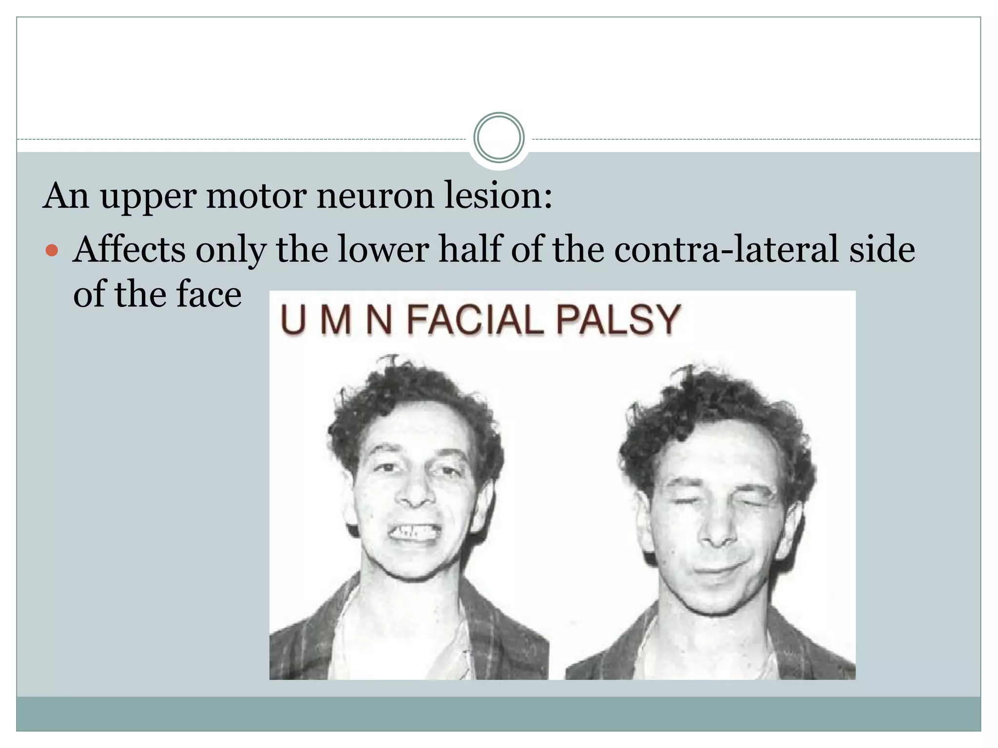 Facial nerve palsy | PPTX