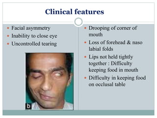 Facial nerve palsy | PPTX