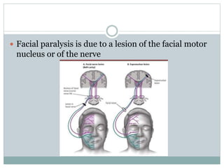 Facial nerve palsy | PPTX