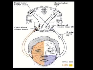 Facial Nerve Palsy Upper Motor Neuron