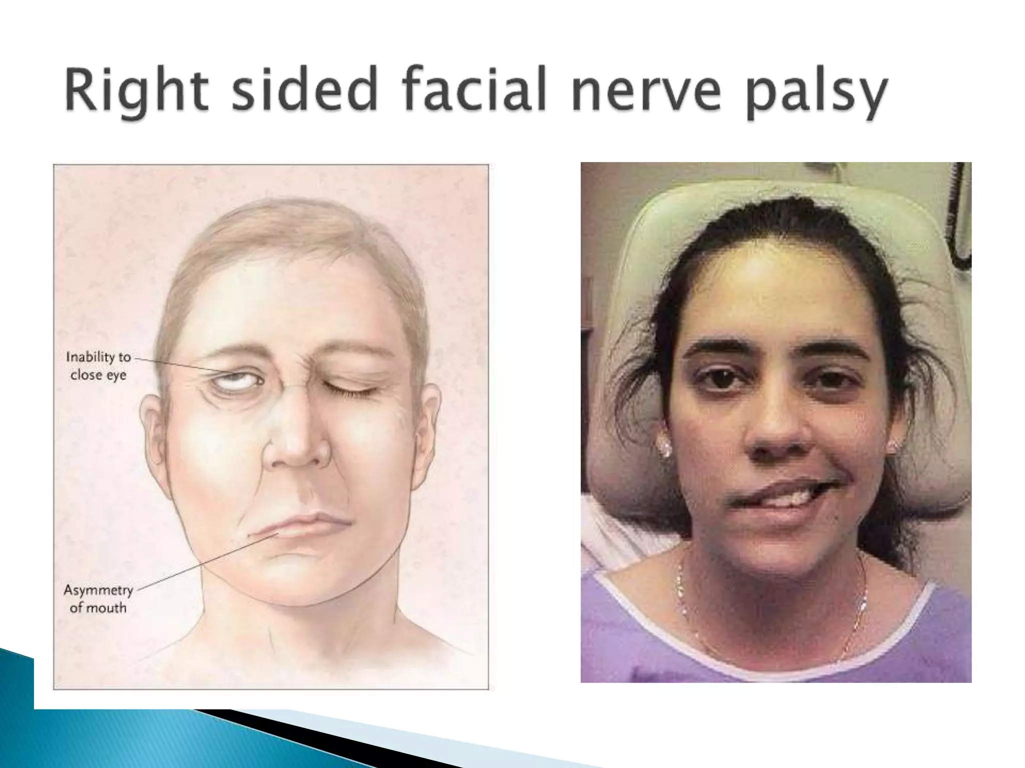 facial_nerve_palsy.ppt