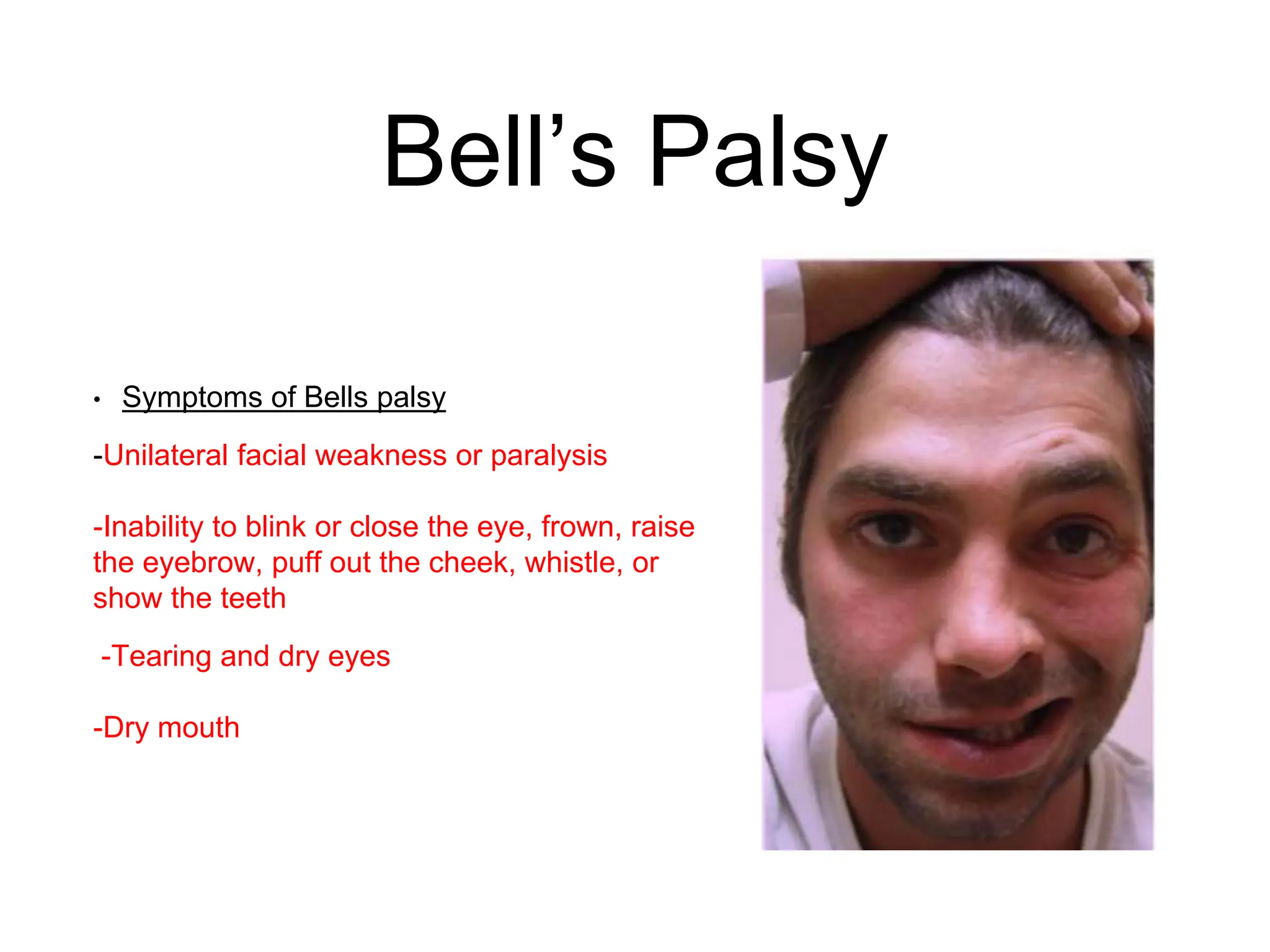 Facial nerve palsy.7th cranial nerve of the system | PPTX