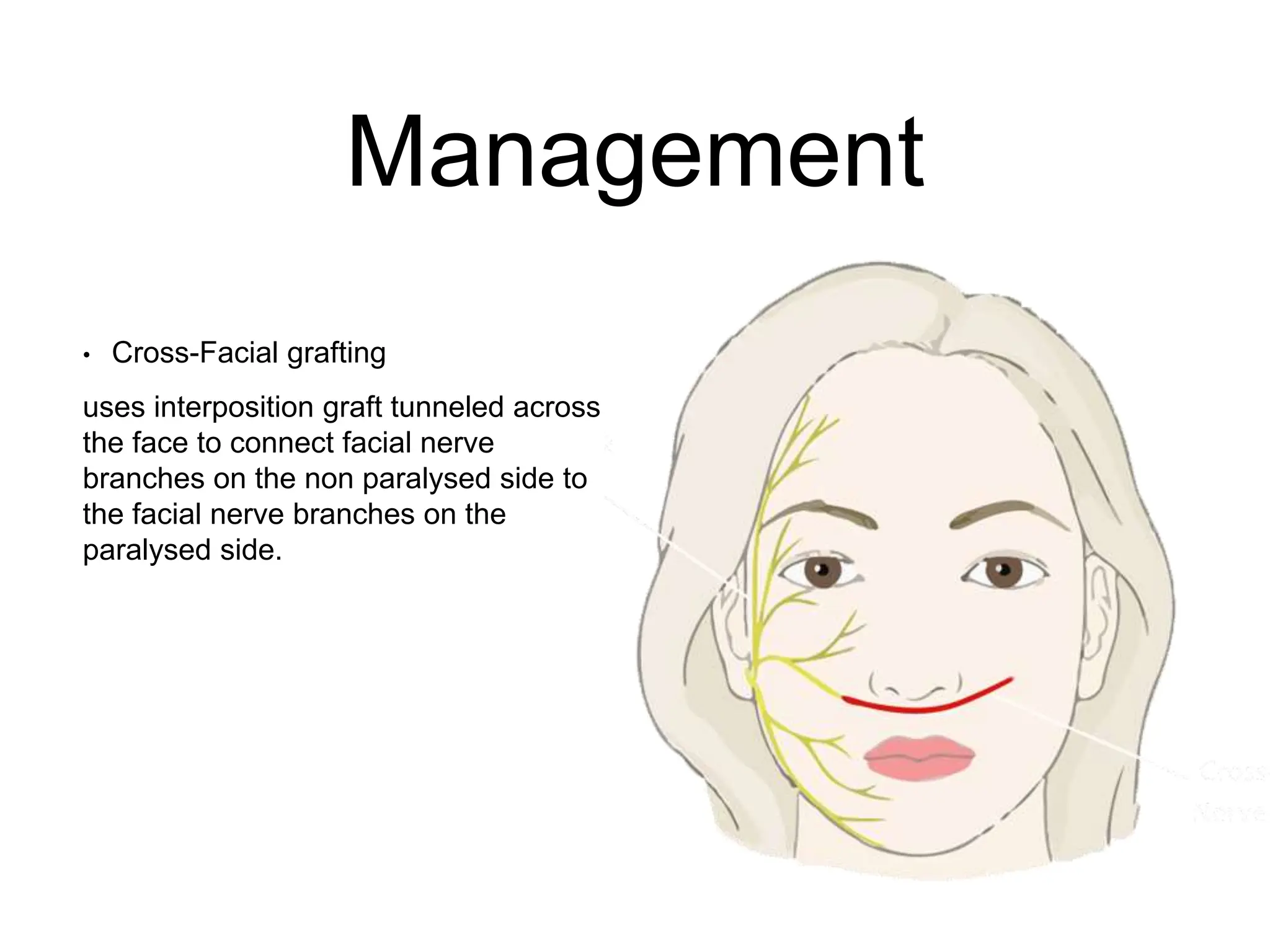 Facial nerve palsy.7th cranial nerve of the system | PPTX