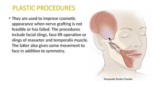Facial Nerve Anatomy, Diseases And its Management | PPTX