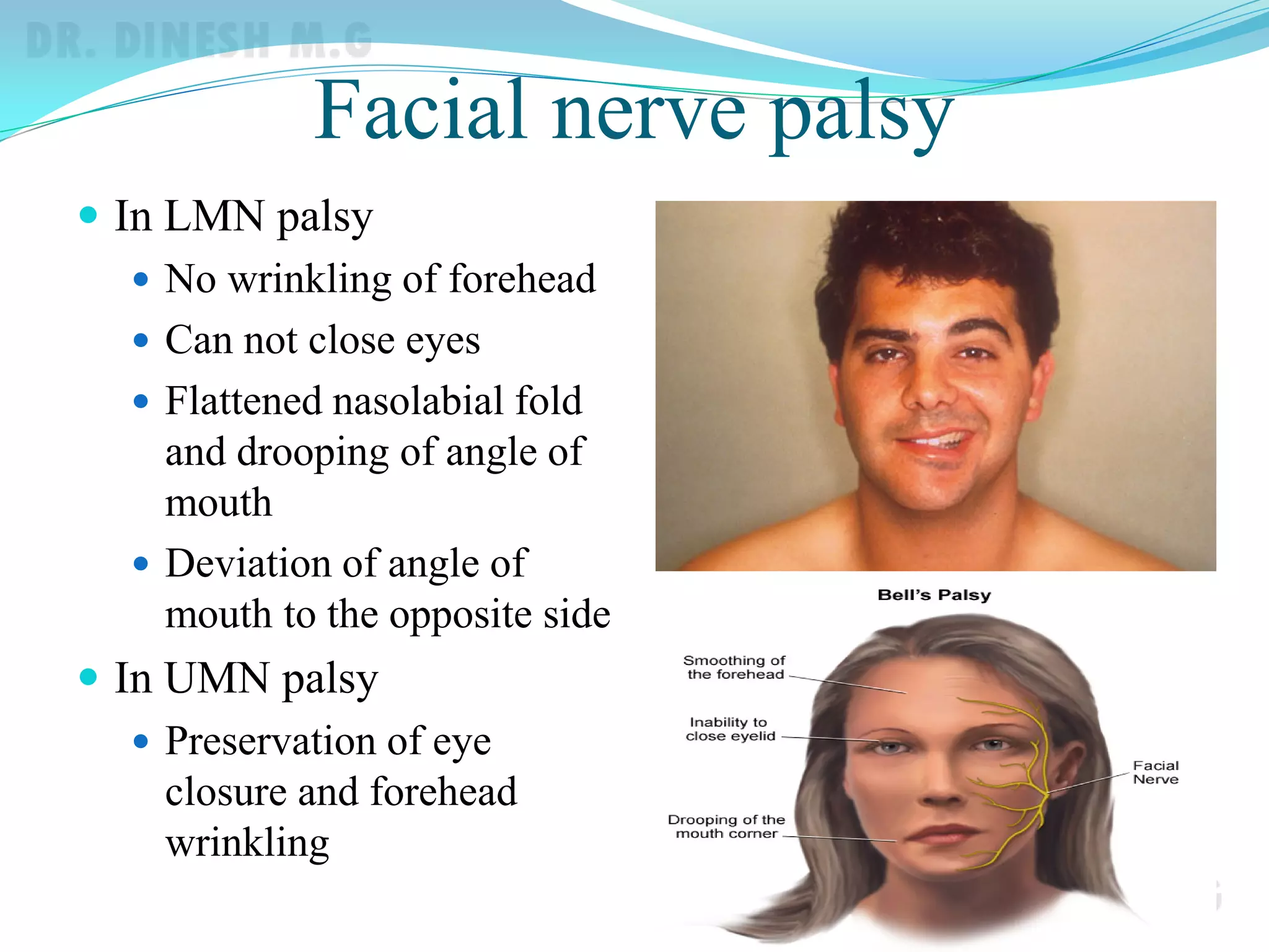 Facial nerve palsy & Trigeminal neuralgia | PDF