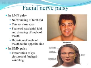 Facial nerve palsy & Trigeminal neuralgia | PDF