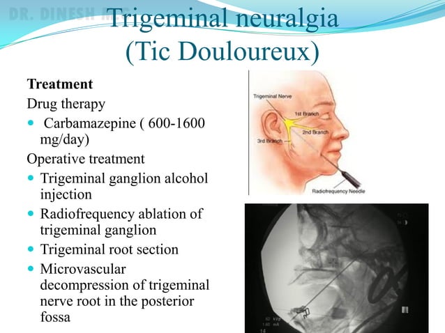 Facial nerve palsy & Trigeminal neuralgia | PDF