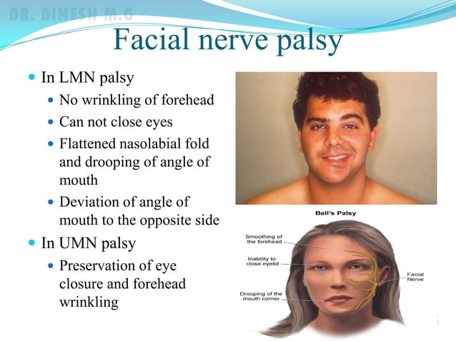 Facial nerve palsy & Trigeminal neuralgia | PPT