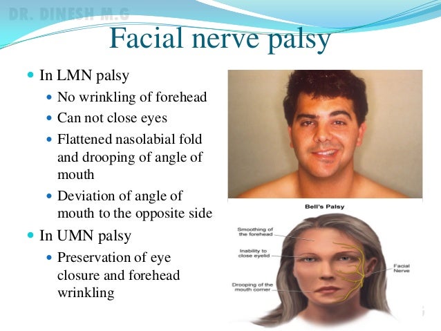 Facial nerve palsy & Trigeminal neuralgia
