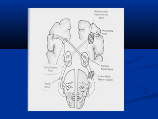 Facial nerve paralysis | PPT