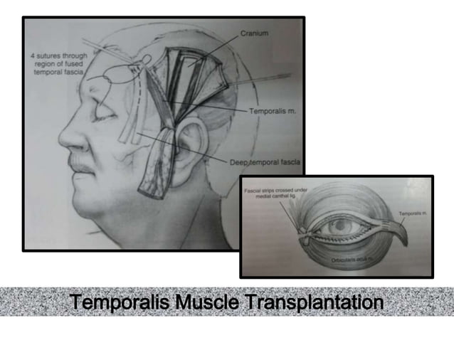 Facial paralysis reconstruction | PPT