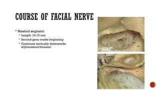 facial nerve Anatomy and leison and investigationspptx | PPTX